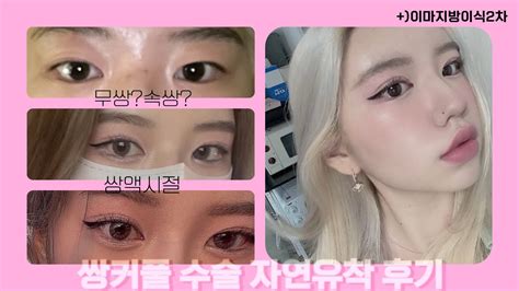 Vlog4 운동아닌 쌍커풀 수술 브이로그 무에서 유로😎 자연유착뒤트임 후기 1일차~일주일 붓기 과정 이마지방이식 2차 진정한 마기꾼은 나일까 눈