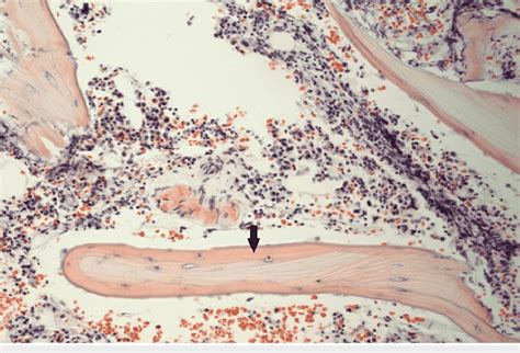 Congo Red Stain Of The Bone Marrow Biopsy Showing Amyloid Deposits In