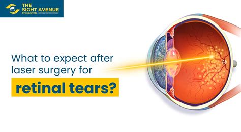 How Does A Retinal Laser Work Retinal Physician Is There A Future