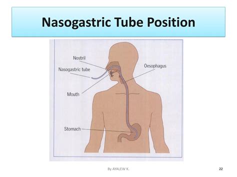 Nasogastric Tube Insertion Pdf