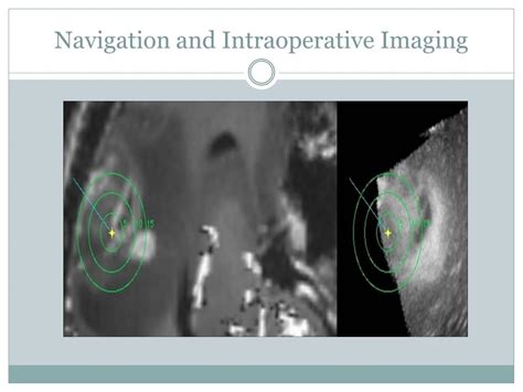 Ppt Intraoperative Mapping Of The Corticospinal Tracts With