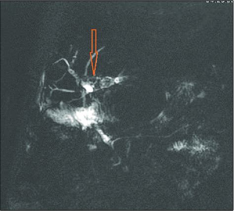 Magnetic Resonance Cholangiopancreatography Showing Intrahepatic Stones Download Scientific