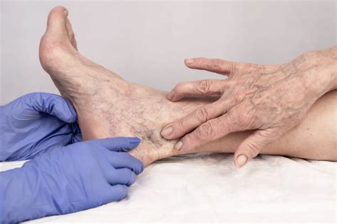 Spider Vein Treatment Conditions Tristate Vein Specialists