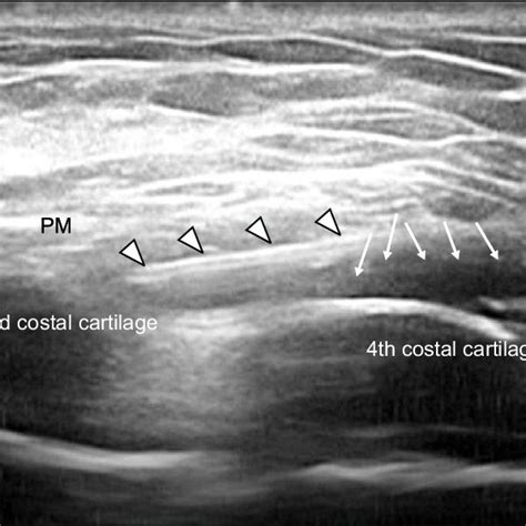 Ultrasound Image Of 2nd Injection Of Modified Pecs Ii Block Pectoralis Download Scientific