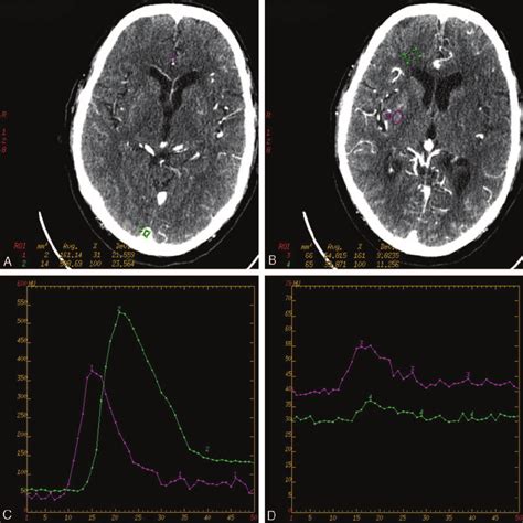 the regions of interest roi for an arterial input aca and venous