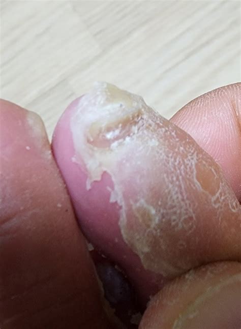 발 피부 벗겨짐발 사진 주의 지식in