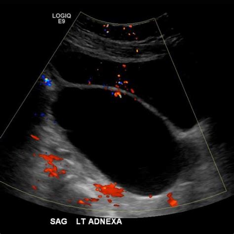 Sagittal View Of Left Adnexal Cyst Yellow Arrow On Ct Abdomen And