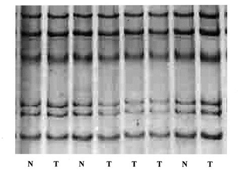 Sscp Analysis Of The Pcr Products Of Exon 2 P16 Gene No Mobility Shift Download Scientific