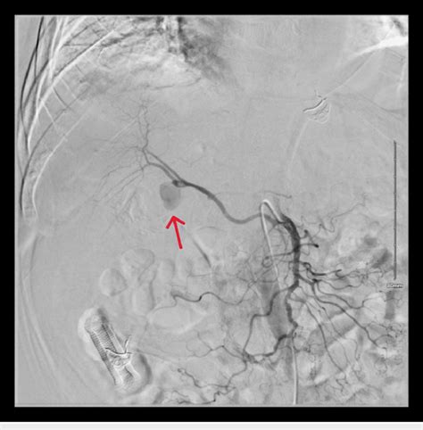 Angiography Before Embolization Showing A Cystic Artery Pseudoaneurysm Download Scientific