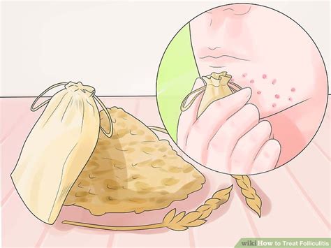 3 Ways To Treat Folliculitis WikiHow