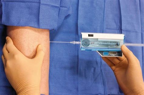 Global Compartment Syndrome Monitoring Devices Market Is Estimated To