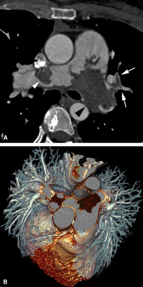 Figure 1 From Primary Intimal Pulmonary Artery Sarcoma A Diagnostic Challenge Semantic Scholar