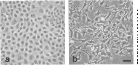 Figure 1 From Loss Of Epithelial Differentiation And Gain Of