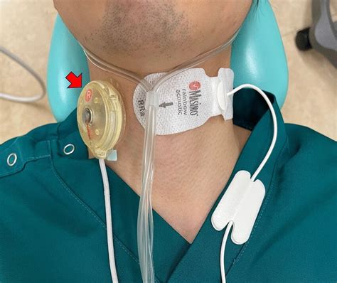 The Cervical Sensor Is Placed Just Lateral To The Thyroid Cartilage And Download Scientific