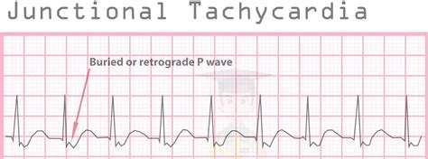 Tachycardia Causes Signs Symptoms Types Diagnosis And Treatment