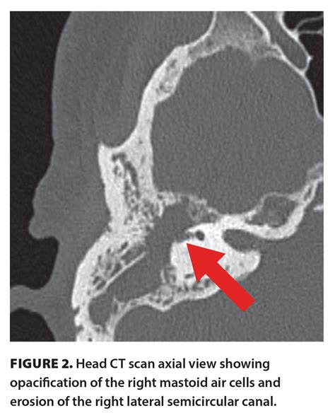 Active Squamous Chronic Otitis Media And Labyrinthine Fistula The