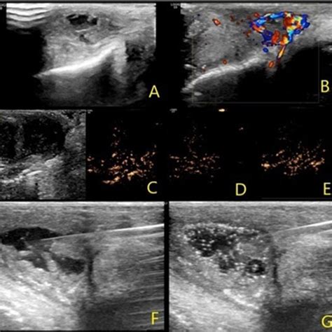 A A Heterogeneous Echogenic Zone At The Root Of The Penis With A
