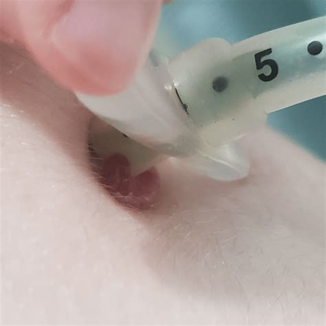 Granulation Tissue Progress Rmedicalgore