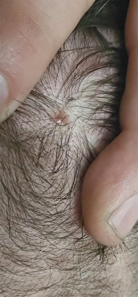 Lump On Scalp Been There For About 9 Months Rdermatologyquestions