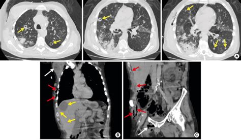 A Three Panel Axial Chest Ct Demonstrating Multiple Lung Nodules With Download Scientific