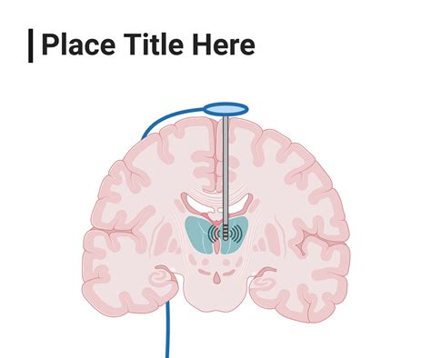 Deep Brain Stimulation Dbs Biorender Science Templates Baysection