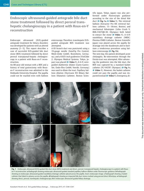 Pdf Endoscopic Ultrasound Guided Antegrade Bile Duct Stone Treatment Followed By Direct