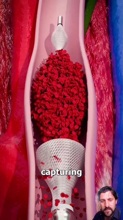 Removing Blood Clots With Vacuum Life Saving Thrombectomy Procedure