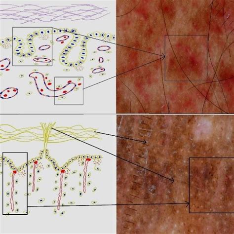 Schematic Diagram Showing A Histopathological And Dermoscopic Download Scientific Diagram
