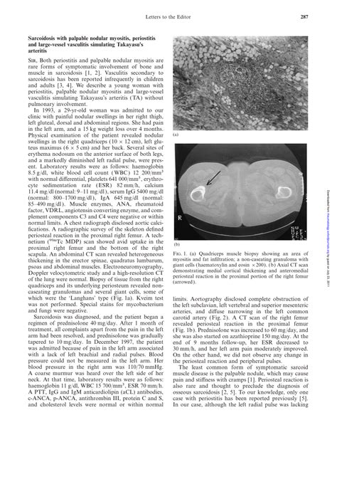 Pdf Sarcoidosis With Palpable Nodular Myositis Periostitis And Large Vessel Vasculitis