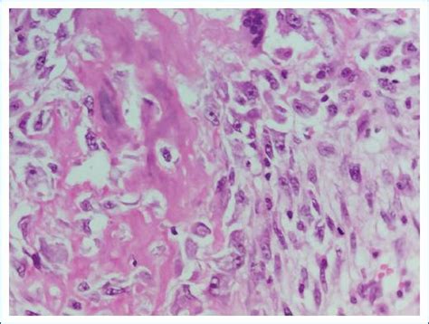 Maxillary Osteosarcoma Morphological Variants Clinicopathological Picture And Literary Revision