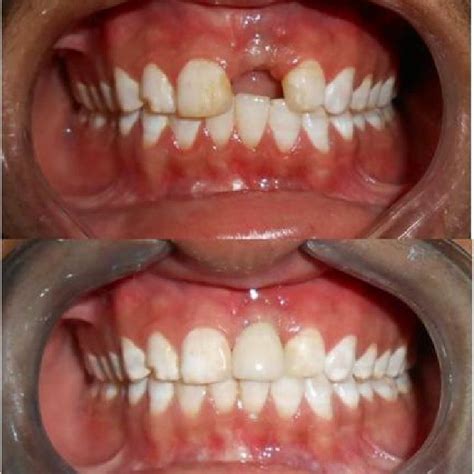 Preoperative Iopa X Ray Showing Extraction Socket Download Scientific Diagram