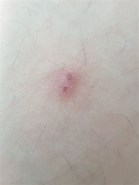 쯔쯔가무시 의심되서 지식in