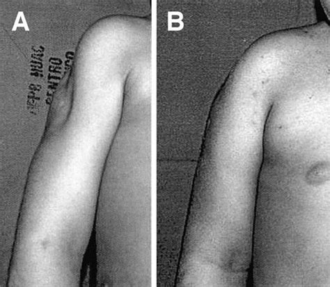 Human Insulininduced Lipoatrophy Diabetes Care American Diabetes