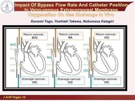 Cannulation And Recirculation In Vv Ecmo Pptx First Aid Injuries