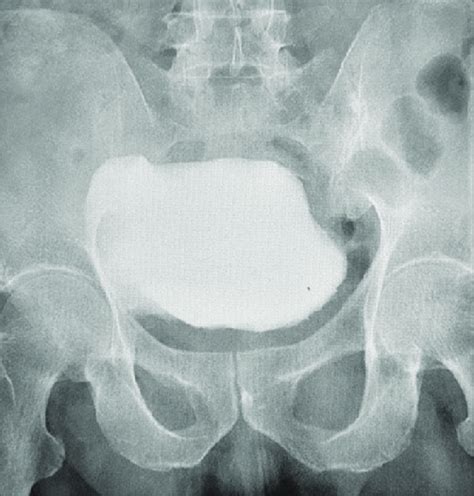 Mcug Shows Significant Post Void Residual Urine Download Scientific