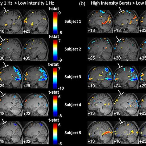 Tms To Dlpfc Produces No Activation In The Targeted Area We Contrasted