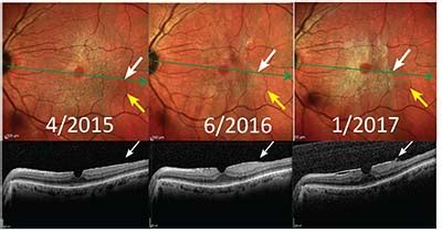 Erm Pathogenesis Three Theories Suggest Defects Of Vitreous And Ilm