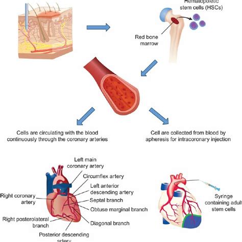Subcutaneous Injection Of G Csf Mobilizing Cells From The Bone Marrow
