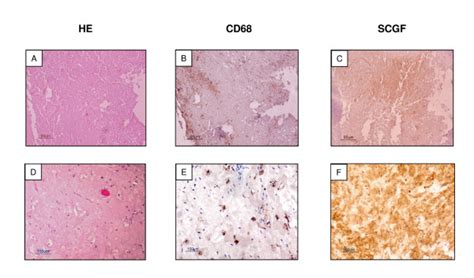 Immunohistochemistry Of Cd68 And Scgf In Gist 5 And Gist 2 A