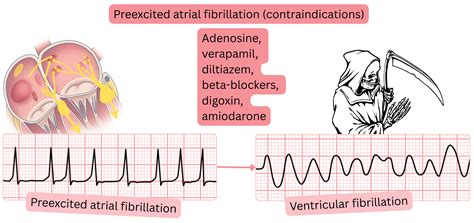 Pharmacological Intravenous Cardioversion Of Atrial Fibrillation