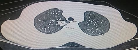 Ct Scan Of The Left Thigh Showing A Significant Deep Seated Mixed Solid Download Scientific