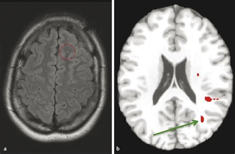 Diffusion Imaging For The Assessment Of Traumatic Brain Injury Radiology Key
