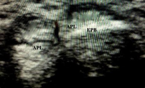 First Dorsal Compartment Of Wrist Showing Two Apl And One Epb Without