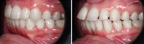 Class Ii Malocclusion With Clear Aligners How To Successfully Treat