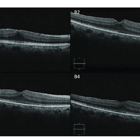 A 69 Year Old Man Complained Of Visual Acuity Loss With Visual Download Scientific Diagram
