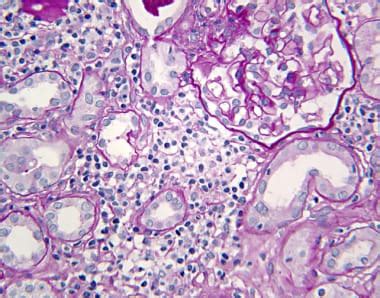 Tubulointerstitial Nephritis Background Pathophysiology Etiology