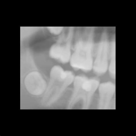 Instancesegmentationteeth Instance Segmentation Dataset By Objectdetectionpr