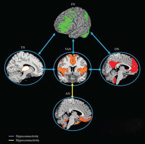 The Salience Network Reduced Connectivity Within The Salience