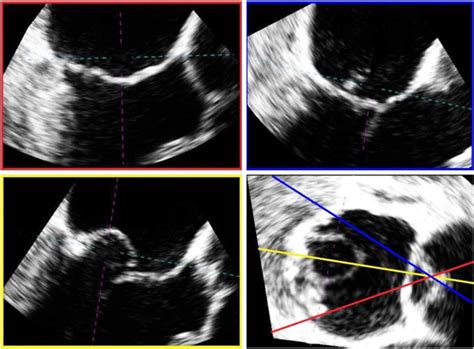 Multiplanar Reconstruction Analysis Of 3d Dataset Clearly Localizing