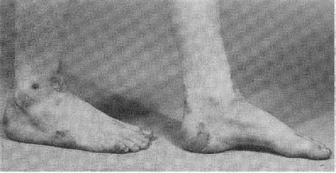 Acrodermatitis Enteropathica Semantic Scholar